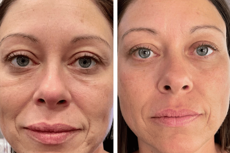 NeoGenPSR – Corrective Skin LI